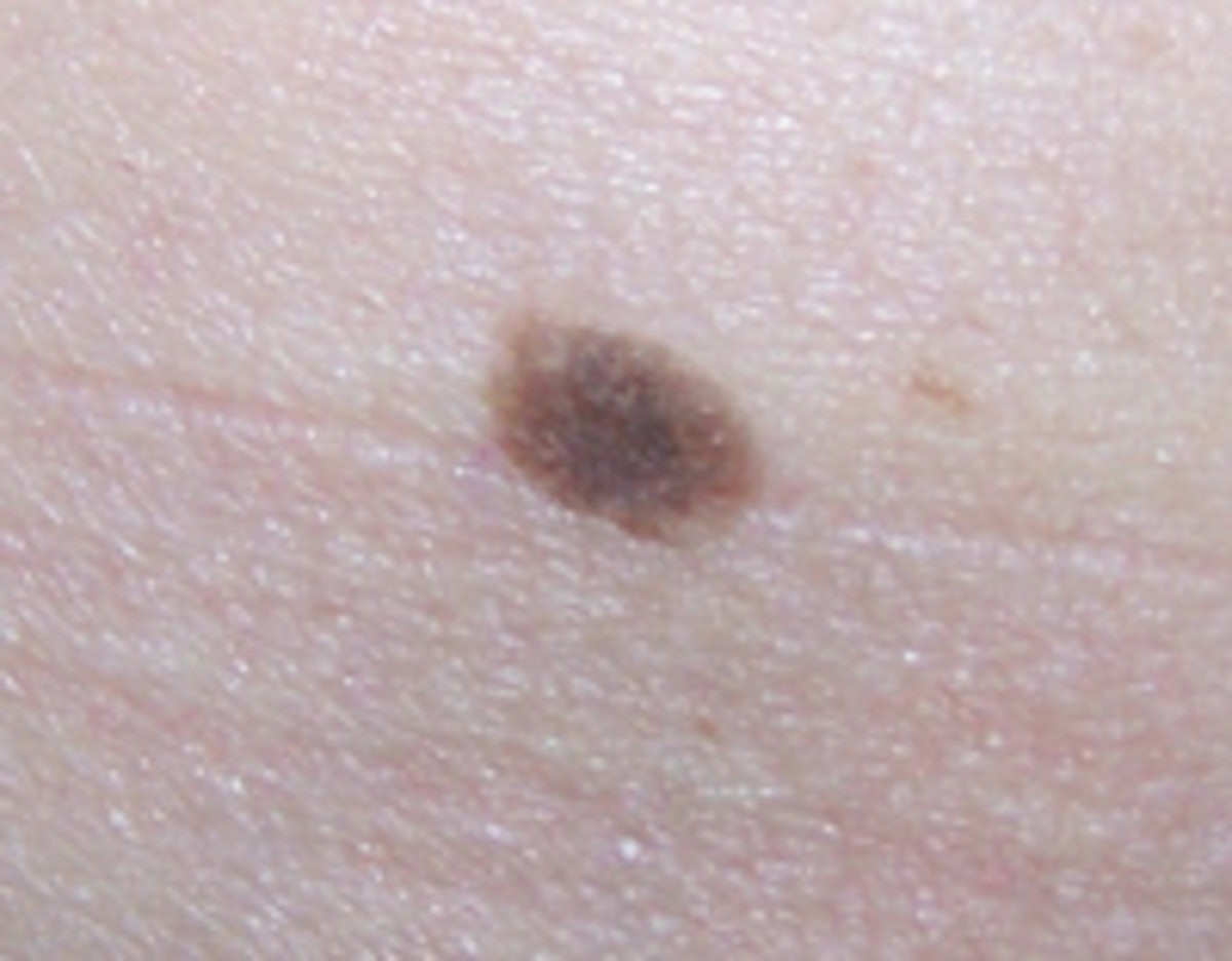 Skin Abnormalities: Separating Harmless From Harmful | Skin Inc.