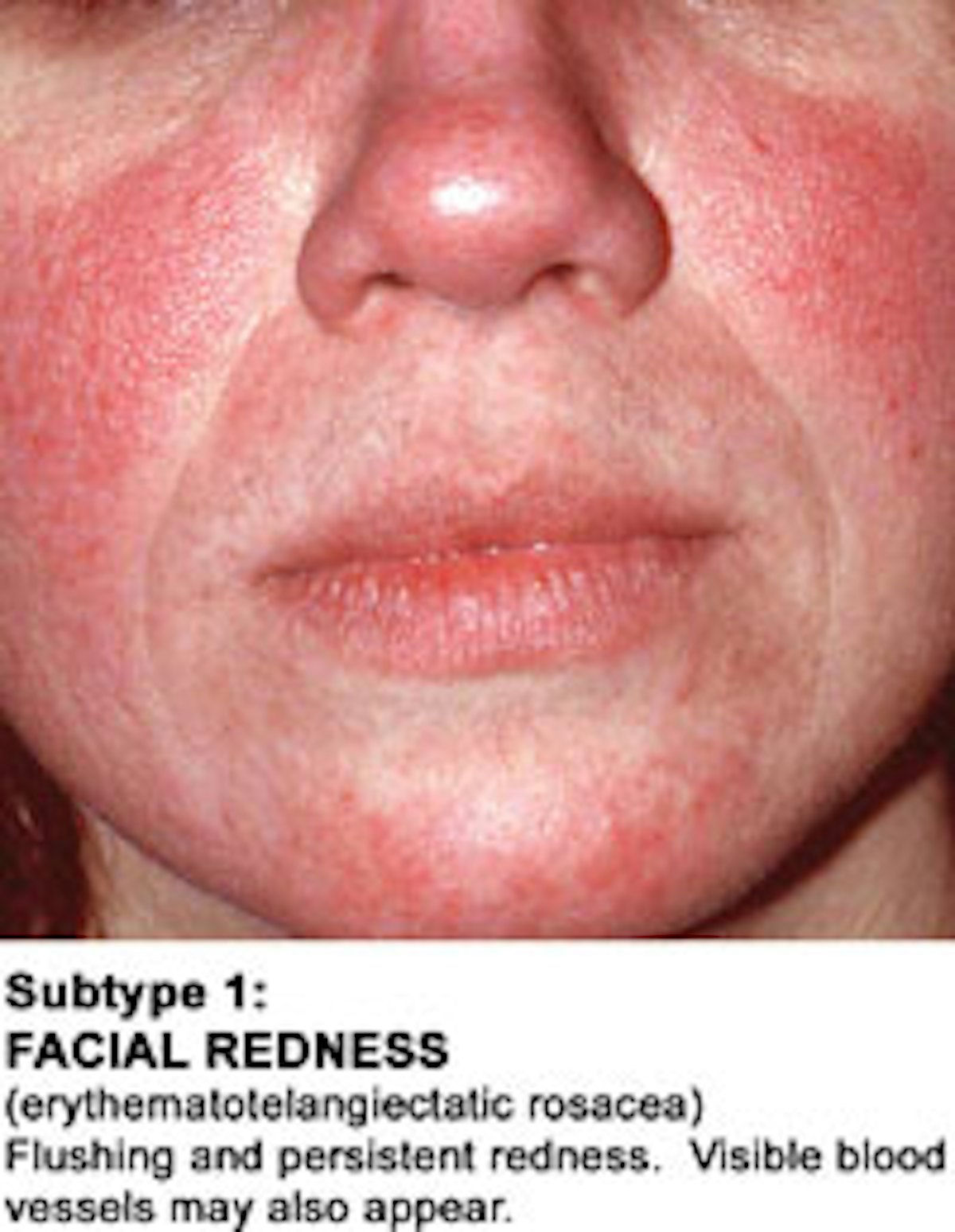 rosacea face
