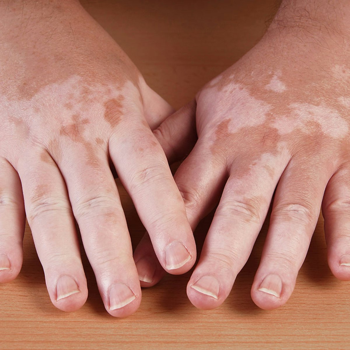 Promising Breakthrough for Repigmentation in Vitiligo Patients | Skin Inc.