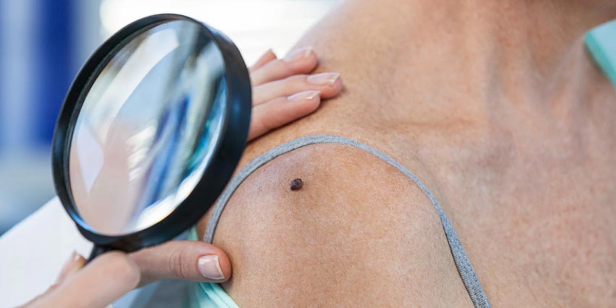 Researchers Unlock Possible Treatment for Rare Skin Cancer | Skin Inc.