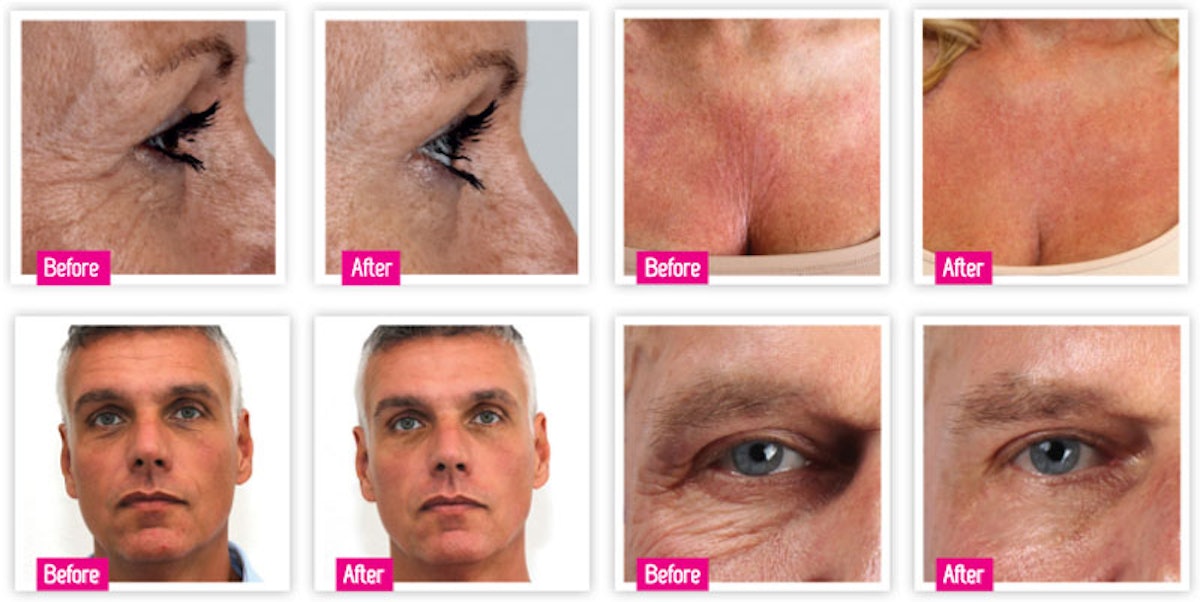 dermatude side effects