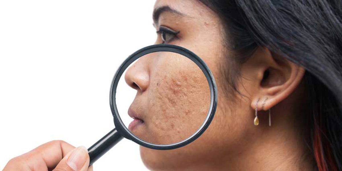 6 Racial & Ethnic Variations In Acne To Consider During Treatment ...