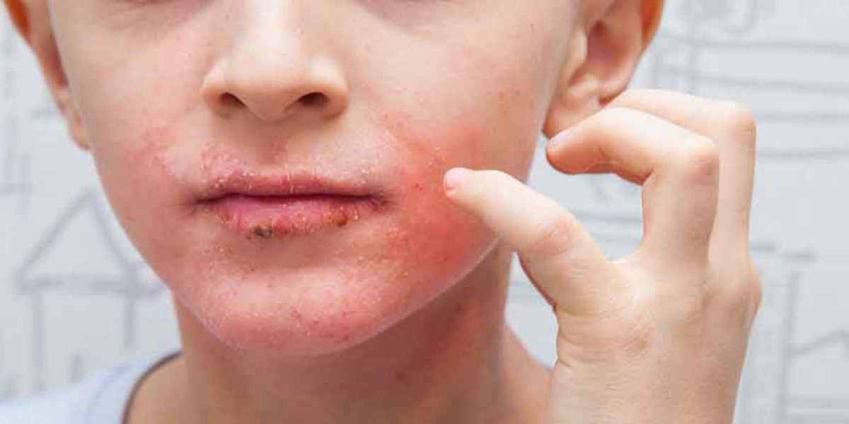 How To Treat Psoriasis On The Lips | Skin Inc.