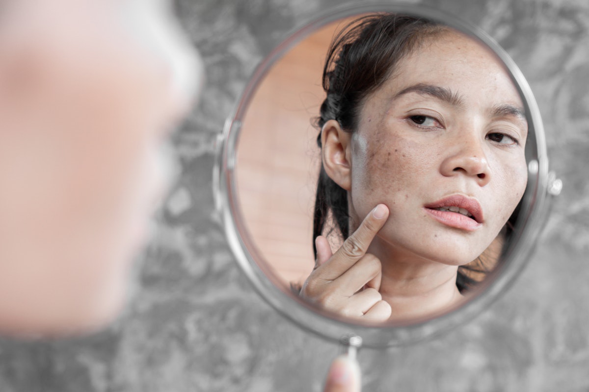 Understanding and Managing Melasma | Skin Inc.